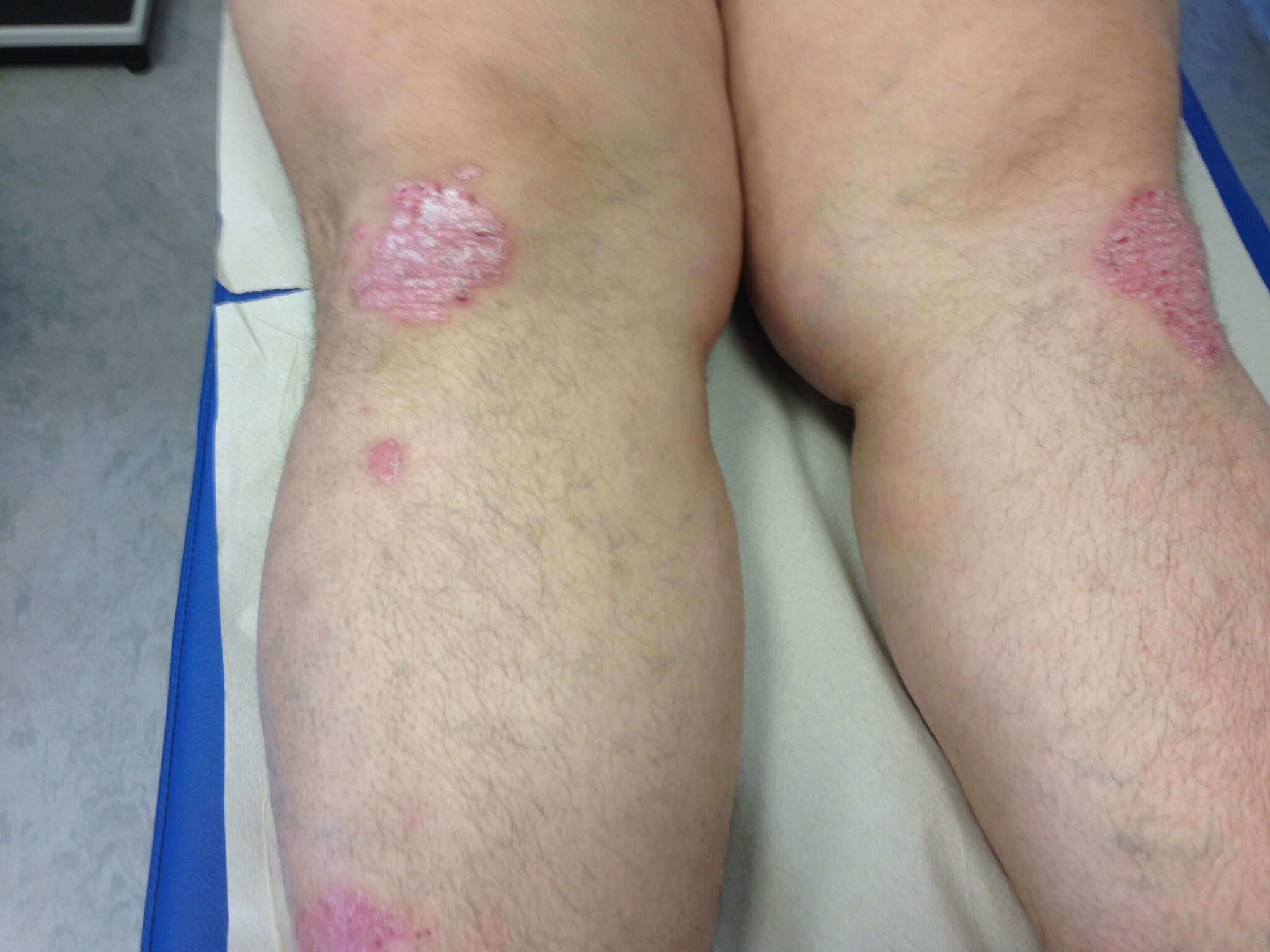 Artrite Psoriasica - sintomi, diagnosi e terapia