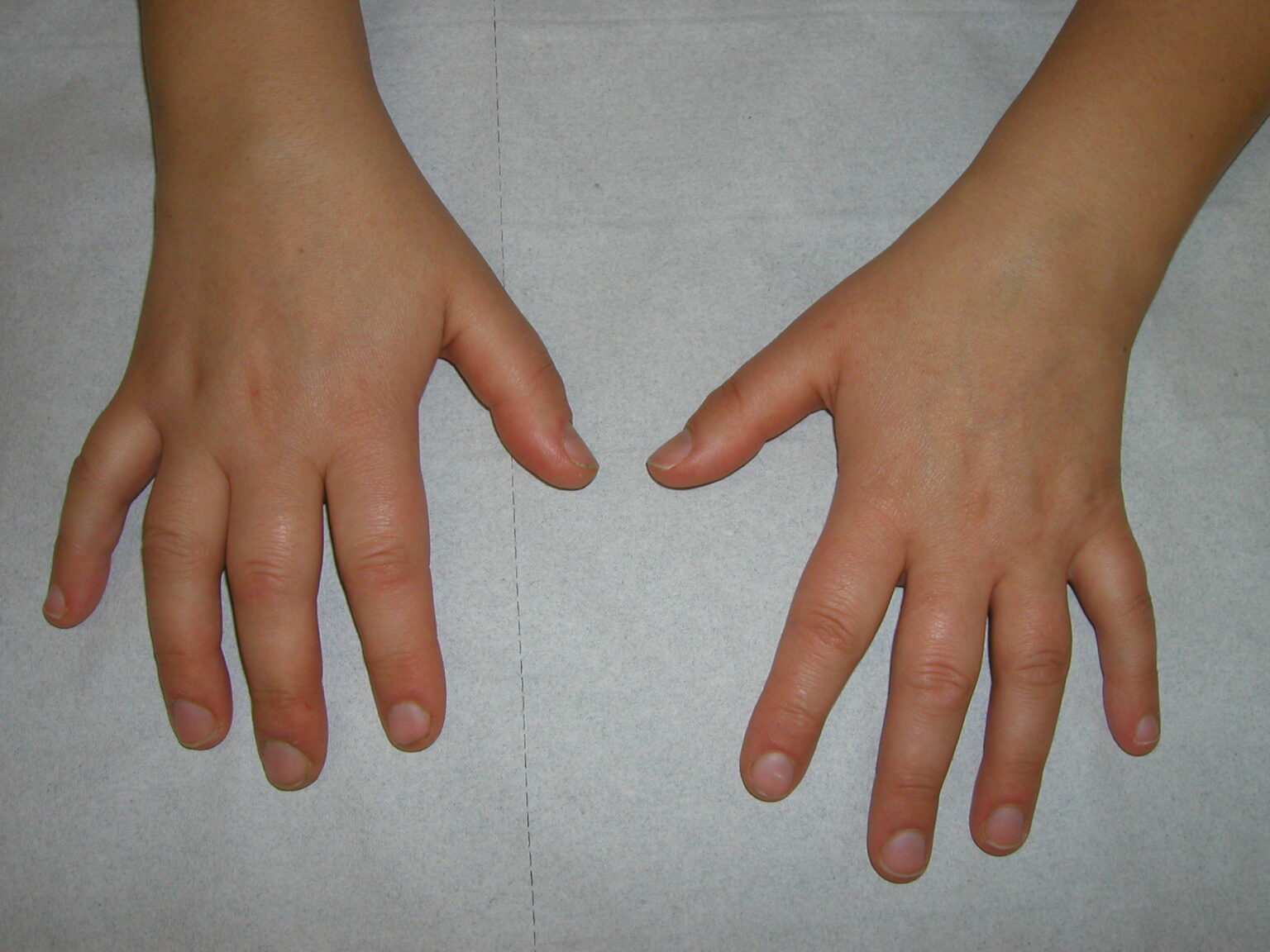 Artrite Reumatoide VIDEO - BRESCIAREUMATOLOGIA Video