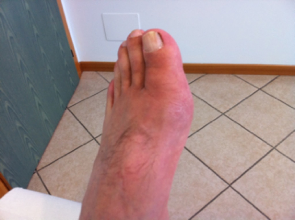 La gotta - caratteristiche cliniche